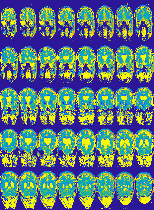 Advanced Signal Processing Techniques Schmidt Mri Lab